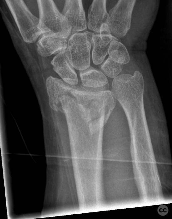 Complex comminuted and impacted distal radius fracture