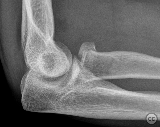 Mason Type Ii Radial Head Fracture at Cooper Meares blog
