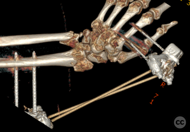 Radiocarpal distraction reduction technique for distal radius fracture