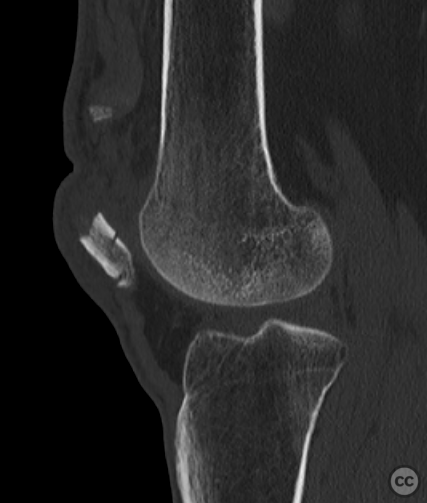 Comminuted patella fracture with inferior pole avulsion