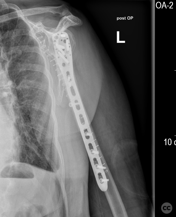 Anterolateral Helix plate - segmental proximal humerus fracture