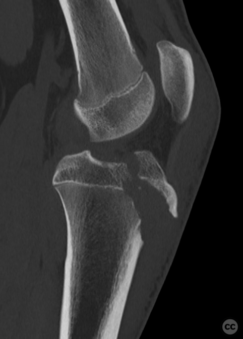 Tibial tubercle fracture - Type III