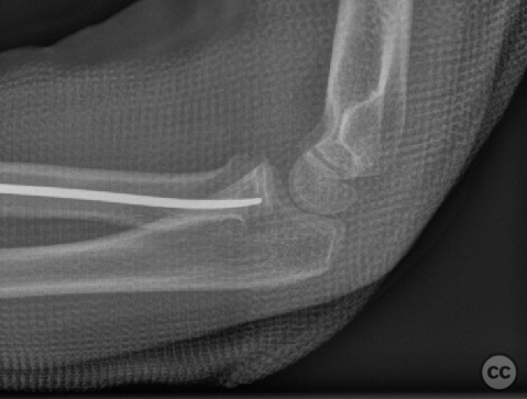 Metaizeau technique radial neck fracture