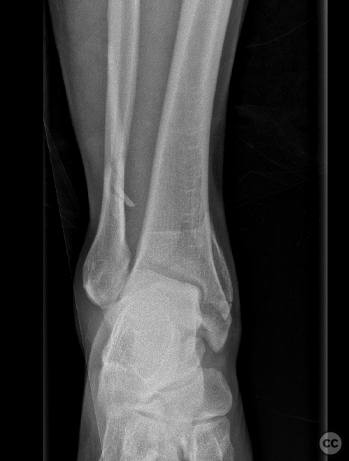 Mason III posterior malleolus fracture dislocation