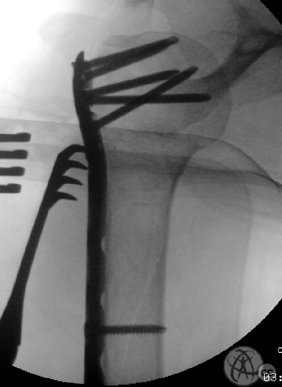 Aggregate lateral approach to a long segmental spiral humerus fracture