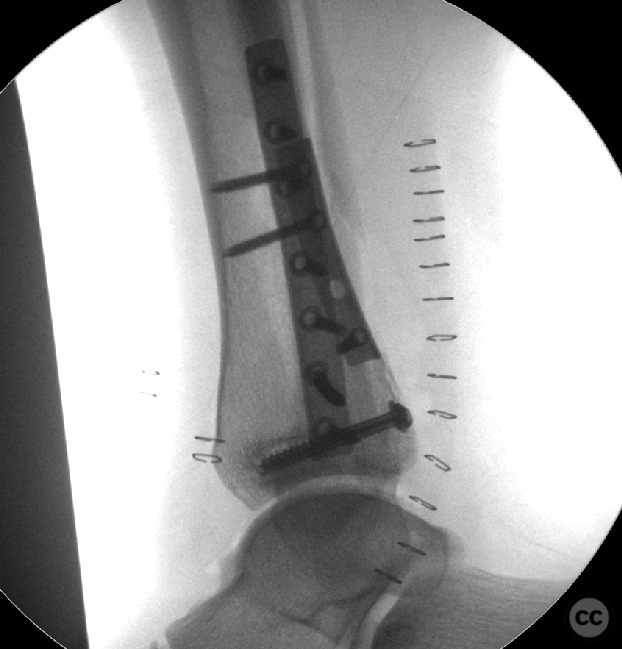 Mason III posterior malleolus fracture dislocation
