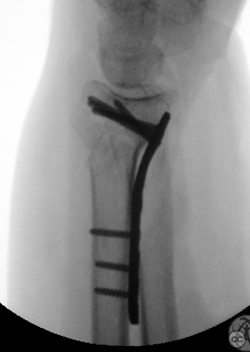 C3 distal radius fracture with distal ulna metaphyseal fracture