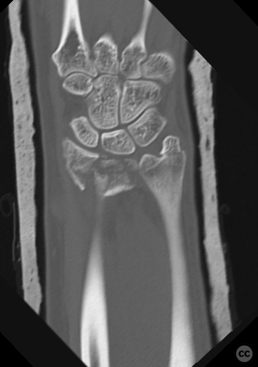 Reduction of the radial column preserving Brachioradialis using a ...