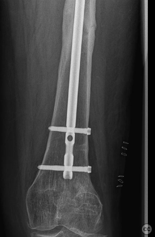 Multifragment intertrochanteric femur fracture with subtrochanteric ...