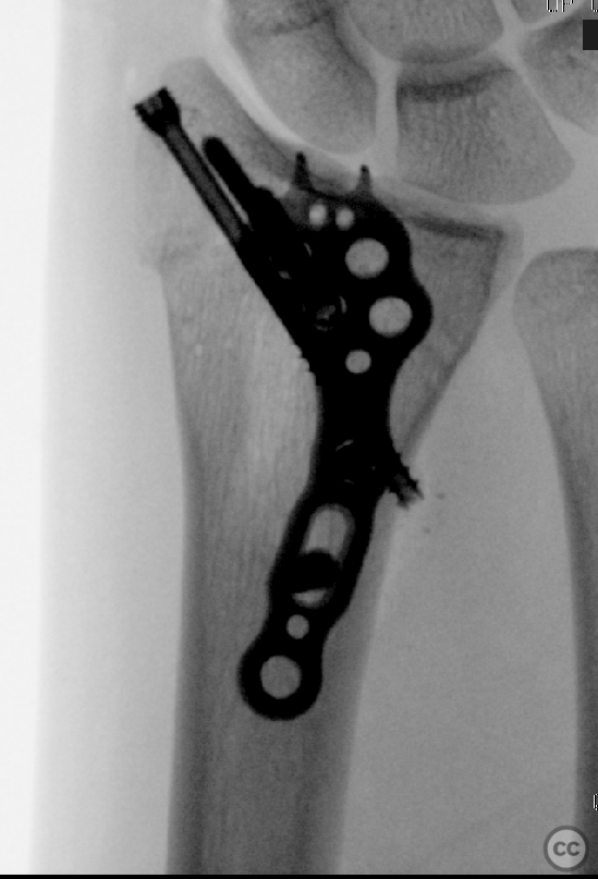 Operative Management of Chauffeur's Fracture with Intraarticular ...