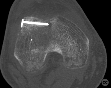 Destructive osteochondral fracture of the lateral femoral condyle ...