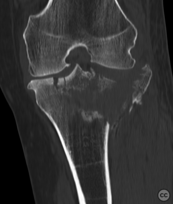 Posterolateral approach to the tibial plateau with femoral epicondylar ...