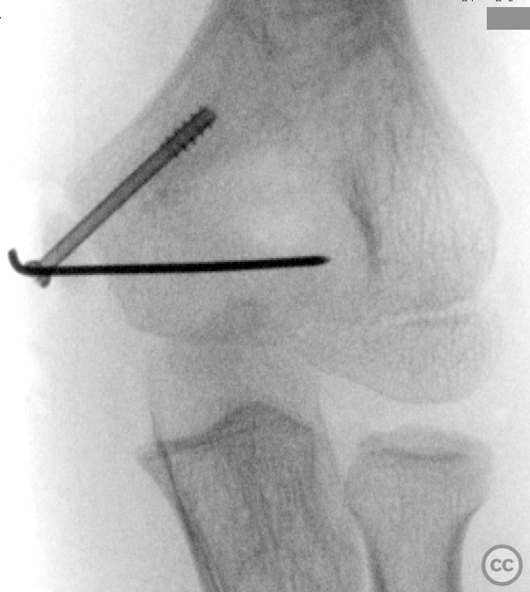 Medial humeral epicondyle avulsion in a 9yo