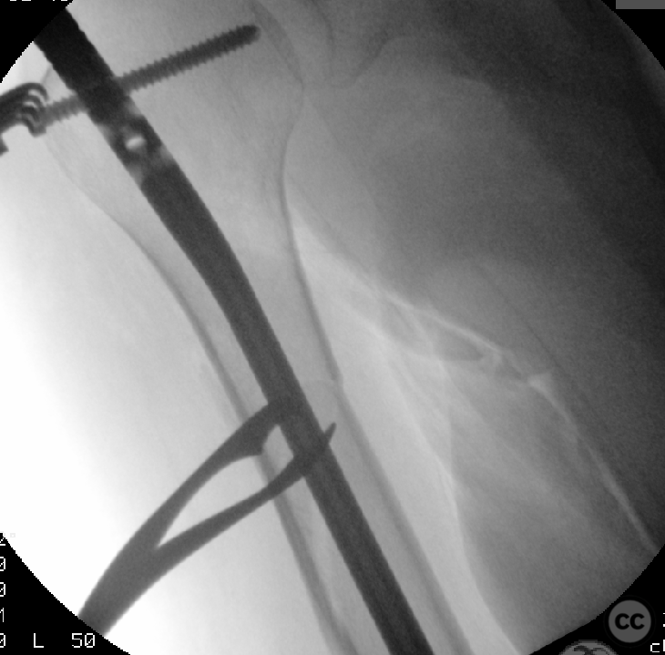 Proximal 1/3 Dorr C humerus open reduction intramedullary nail