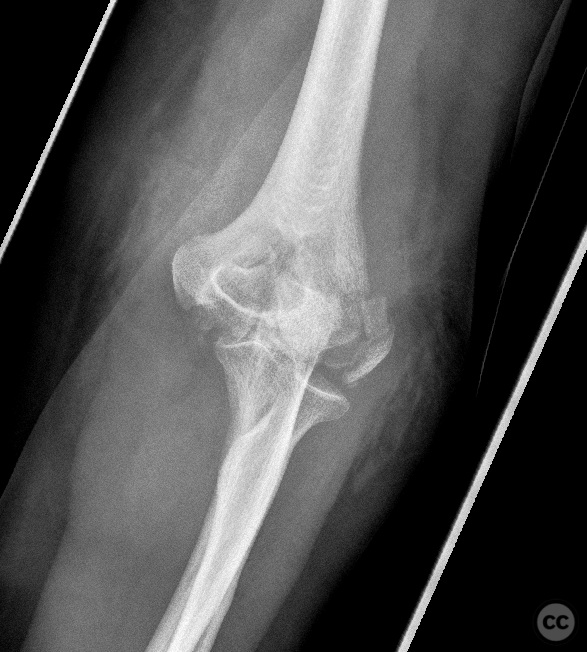 Fracture hemiarthroplasty distal humerus
