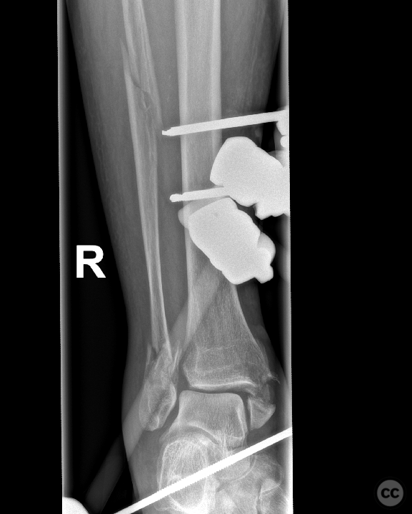Failed pronation - external rotation (PER) ankle fracture dislocation