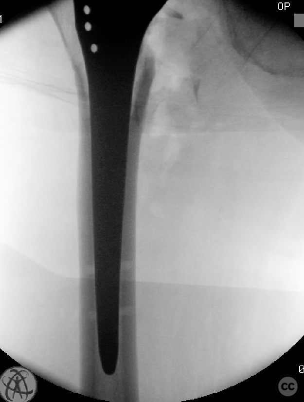 Failure of fixation - Gamma nail cut-out and arthroplasty revision