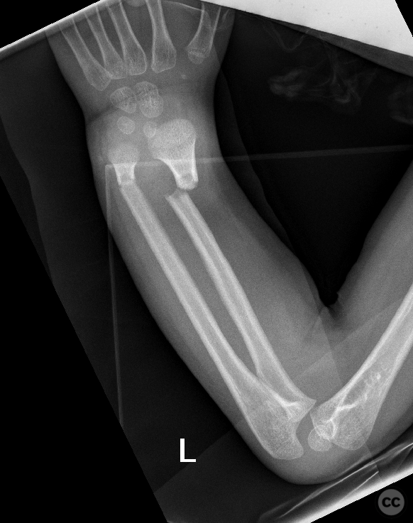 Distal 1/3 both bone forearm fracture in a 6 year old