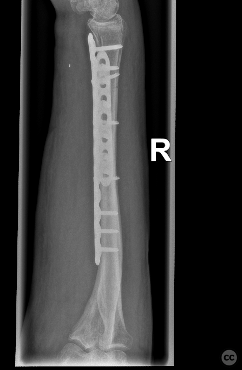 Henry's approach to a segmental radial shaft fracture