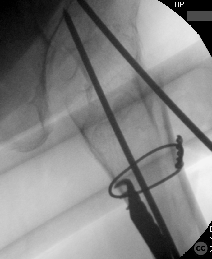 Multifragment intertrochanteric femur fracture with subtrochanteric ...