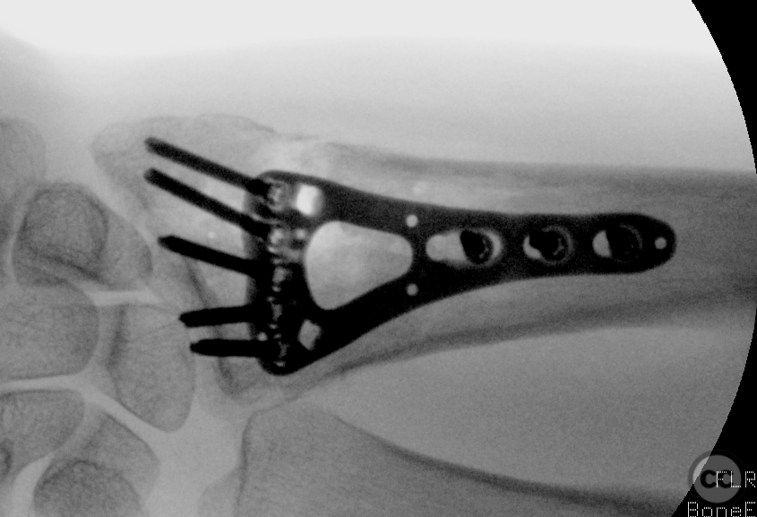 Complex comminuted and impacted distal radius fracture