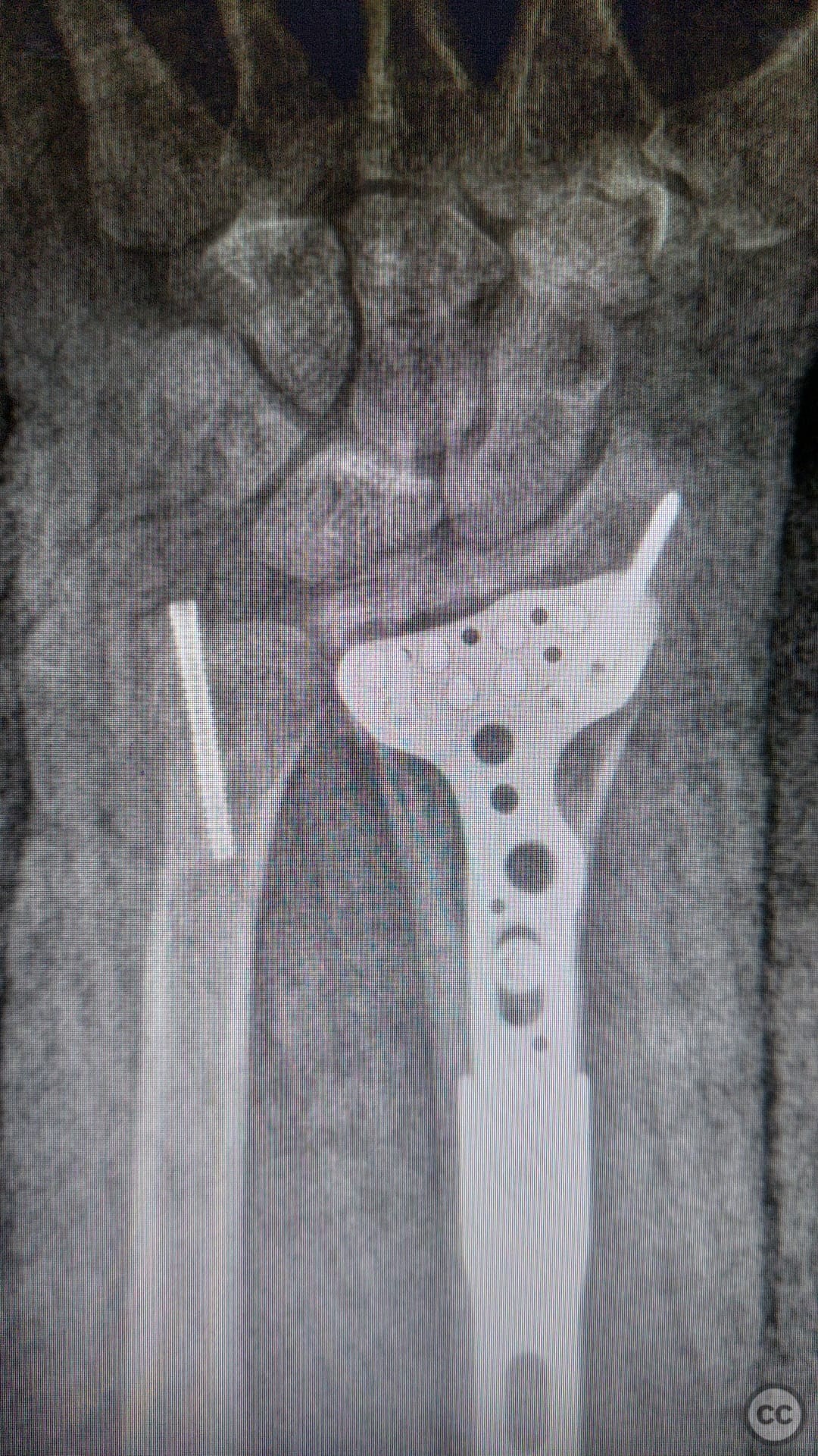 Distal Radius And Ulna Styloid Fracture