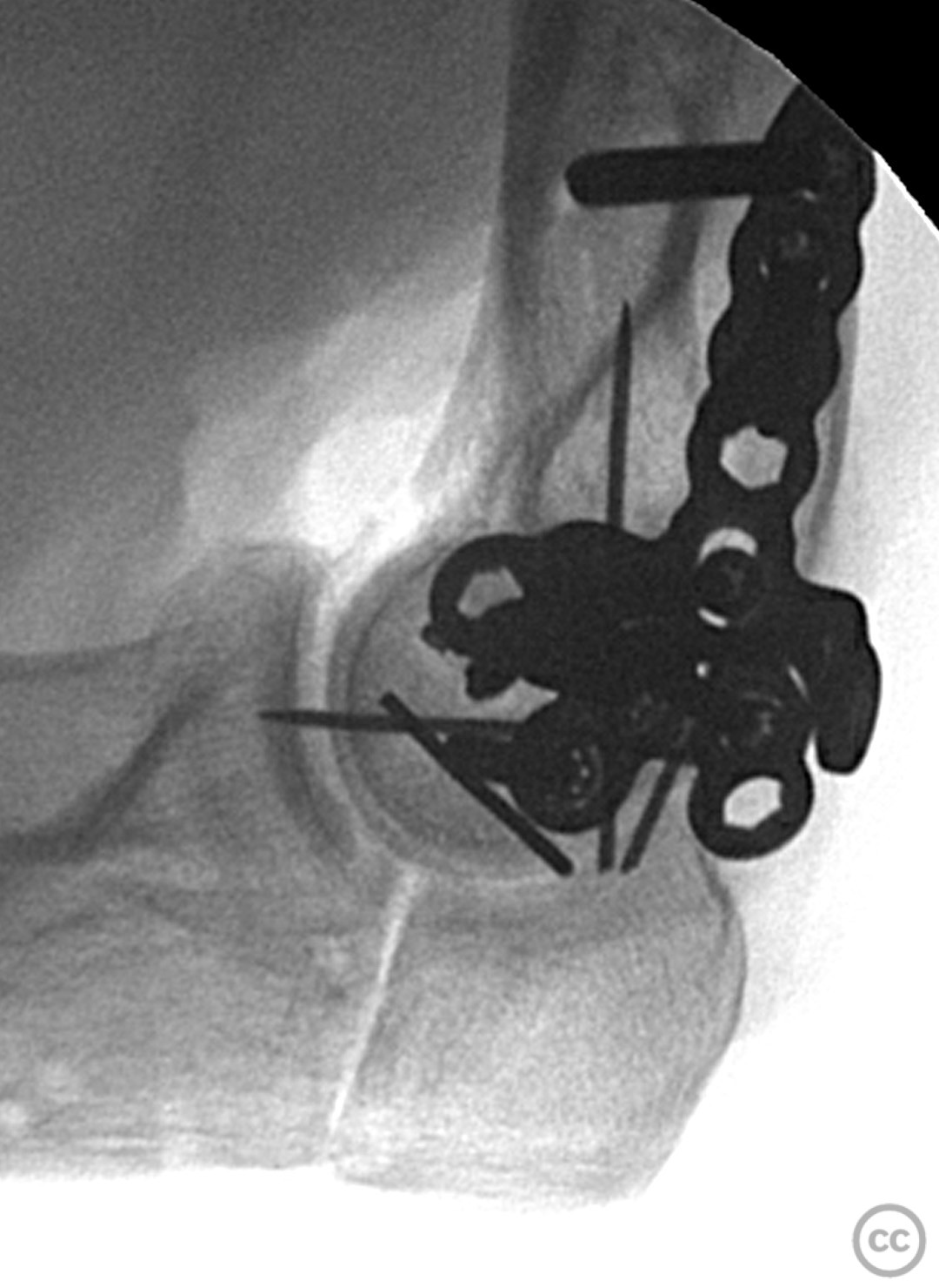 Dubberly 2B articular humerus fracture - skinny wire and radial plate ...