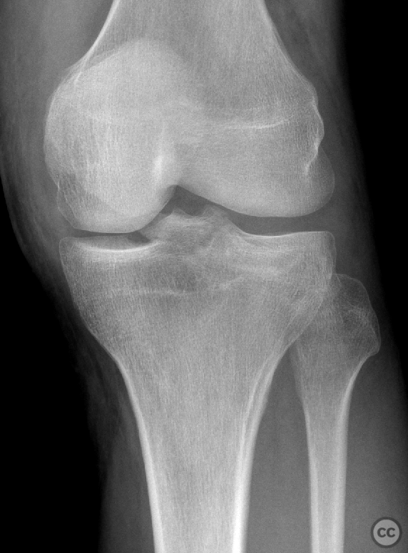 Apple-bite posterolateral corner and ACL / Eminentia Avulsion