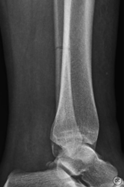 Functional Bimalleolar Ankle Fracture with Syndesmotic Injury and ...