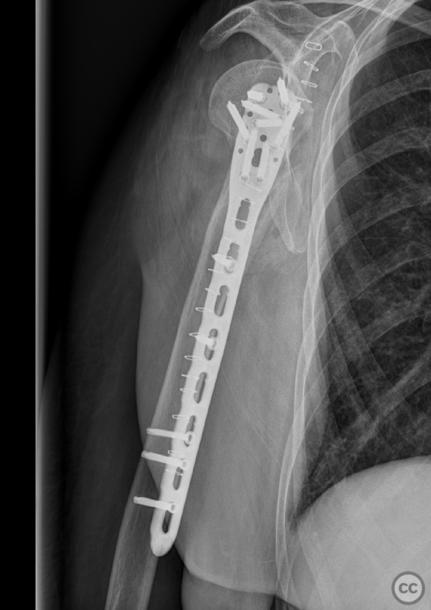 Helix Philos-plate fixation of a comminuted proximal humerus fracture
