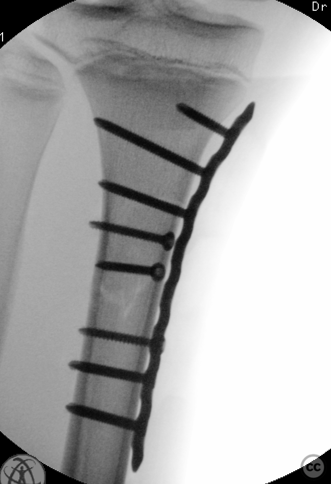 13yo proximal tibial diametaphyseal transition zone fracture