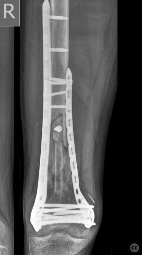 Double plate fixation of a comminuted supra- and intercondylar distal ...