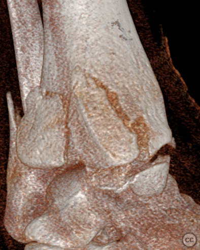 Mason and Molloy 2B Posterior Malleolar Fracture. Anterior collicular ...