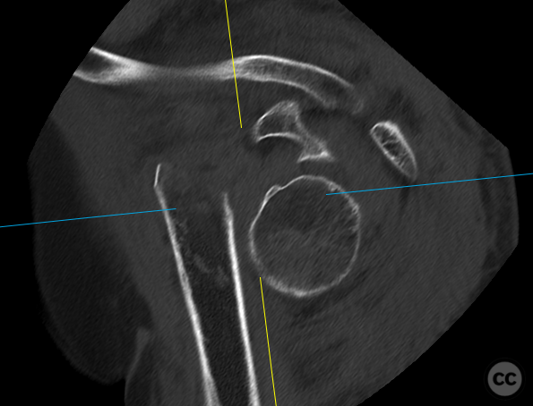 Displaced surgical neck of humerus fracture with brachial plexus ...