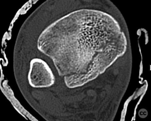 Mason III posterior malleolus fracture dislocation