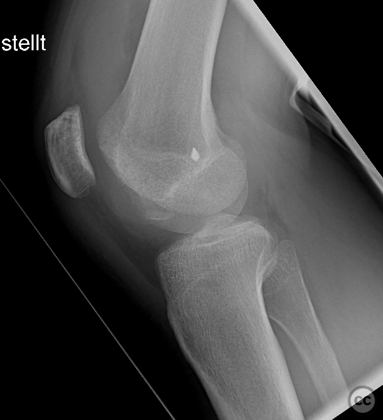 Destructive osteochondral fracture of the lateral femoral condyle ...