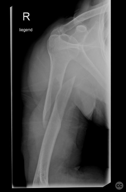 Spiral Humeral Shaft Fracture