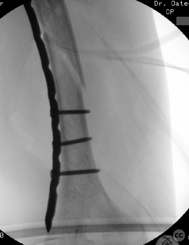 Aggregate lateral approach to a long segmental spiral humerus fracture