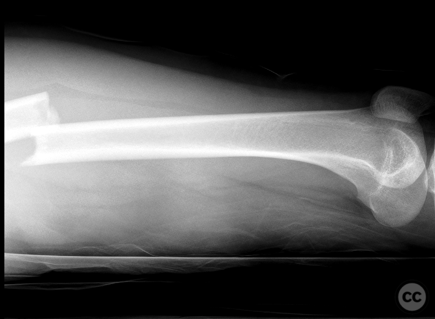 Simple transverse femoral shaft fracture