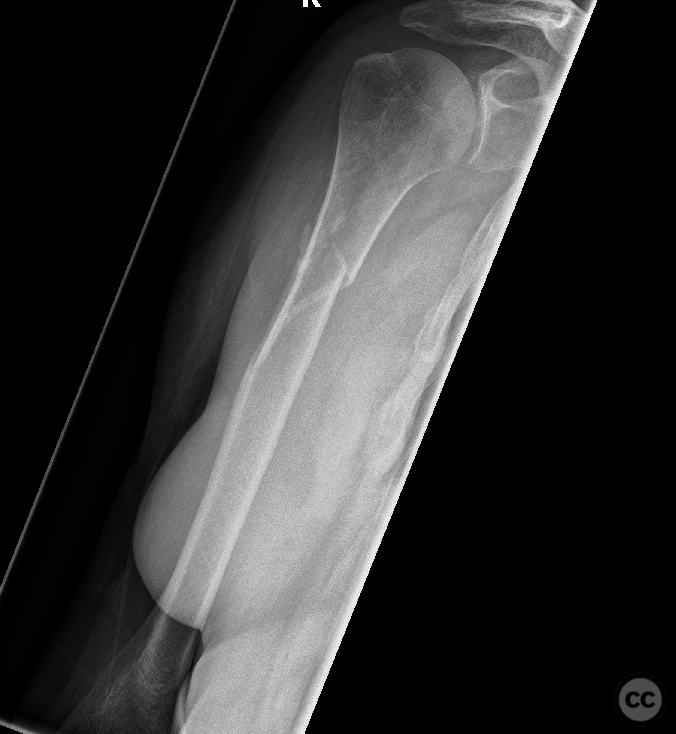 Proximal 1/3 Dorr C humerus open reduction intramedullary nail