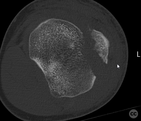 Tibial tubercle fracture - Type III
