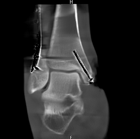Chaput tubercle syndesmosis avulsion Weber C bilmalleolar ankle fracture
