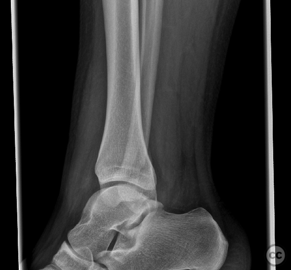 Simple SER Weber B fibula fracture