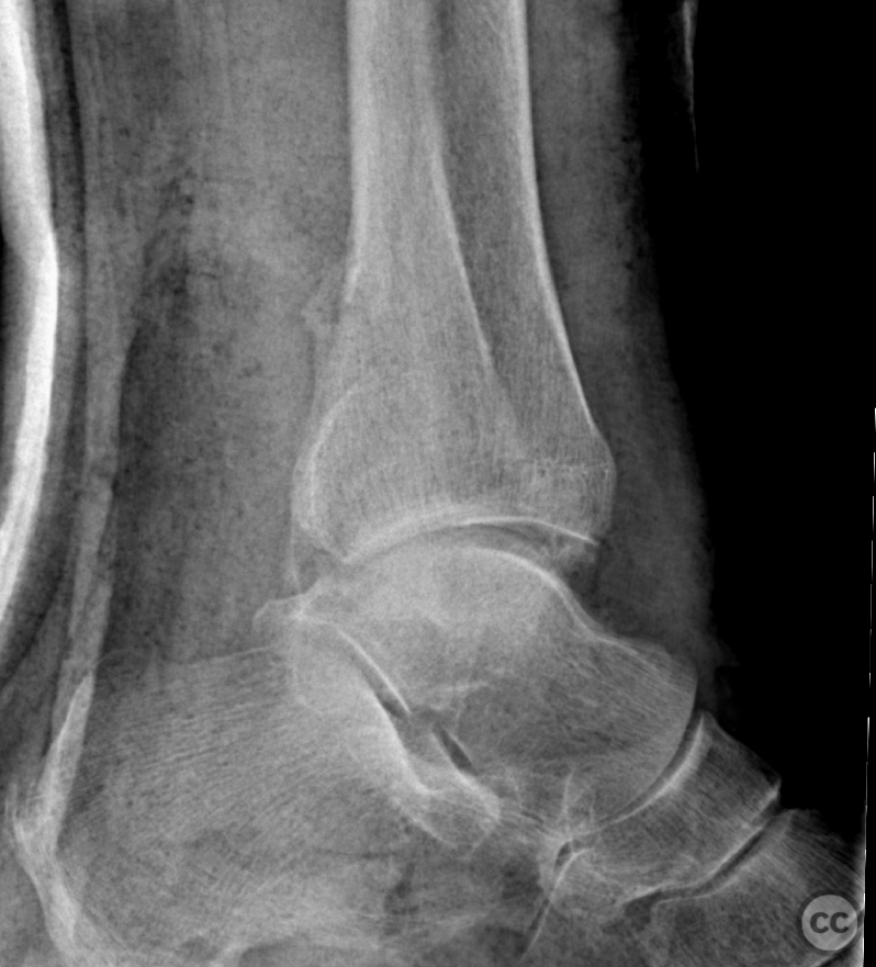 Pronation Abduction (PAb) ankle fracture with Mason 2A lateral plafond ...