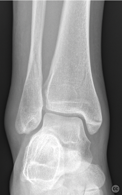 Mason and Molloy 2B Posterior Malleolar Fracture with Posteromedial die ...