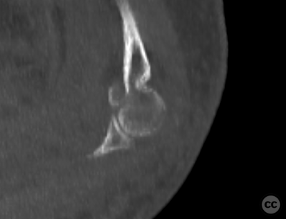 Transolecranon Dubberly 2B fracture dislocation