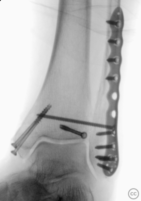Pronation Abduction (PAb) ankle fracture with Mason 2A lateral plafond ...