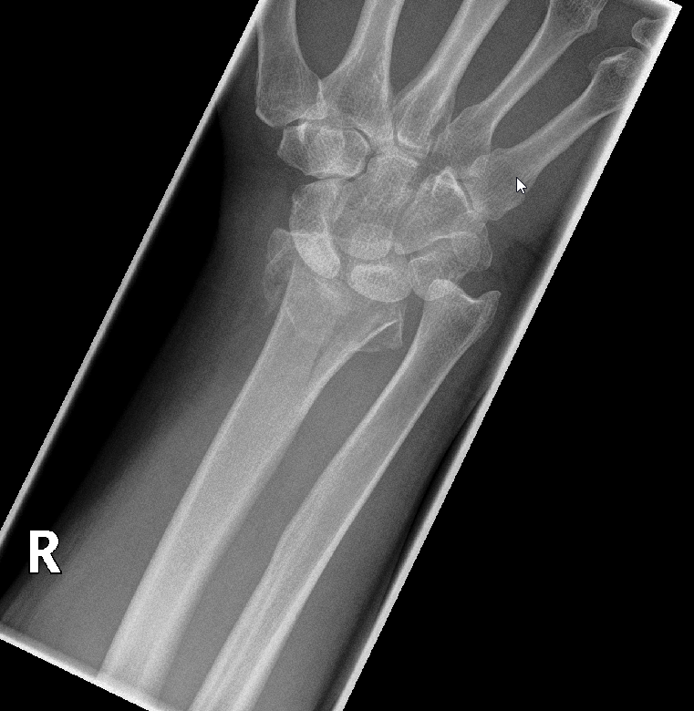 Fracture-Osteotomy distal radius