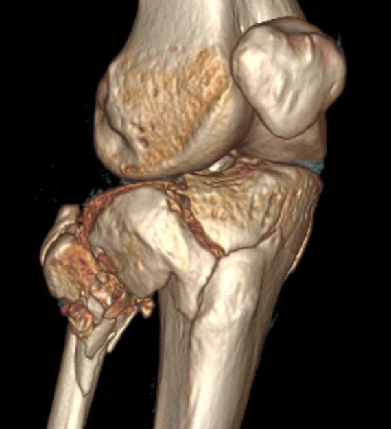 Schatzker VI tri-condylar fracture with pseudo PLC disruption