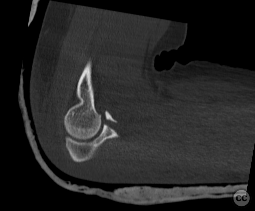 PMRI following elbow dislocation with pMCL insufficiency